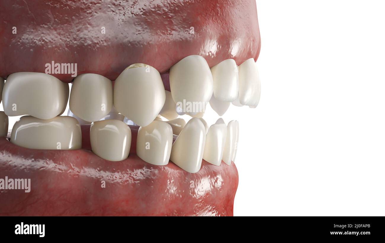 Open bite, illustration Stock Photo - Alamy