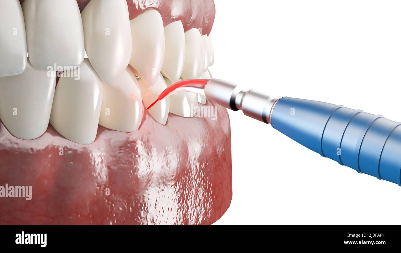 Gum correction, illustration Stock Photo - Alamy
