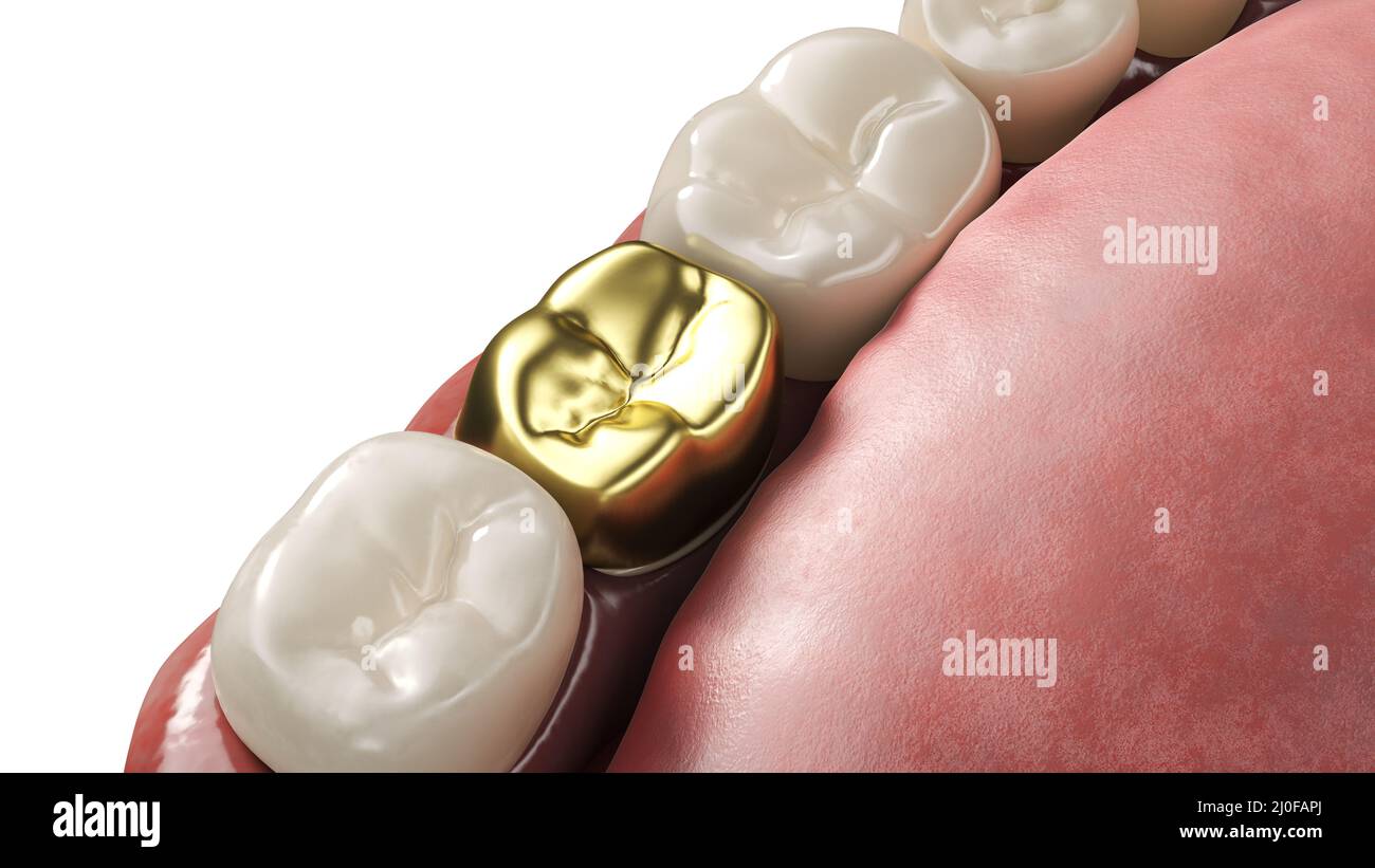 Dental crown, illustration Stock Photo - Alamy