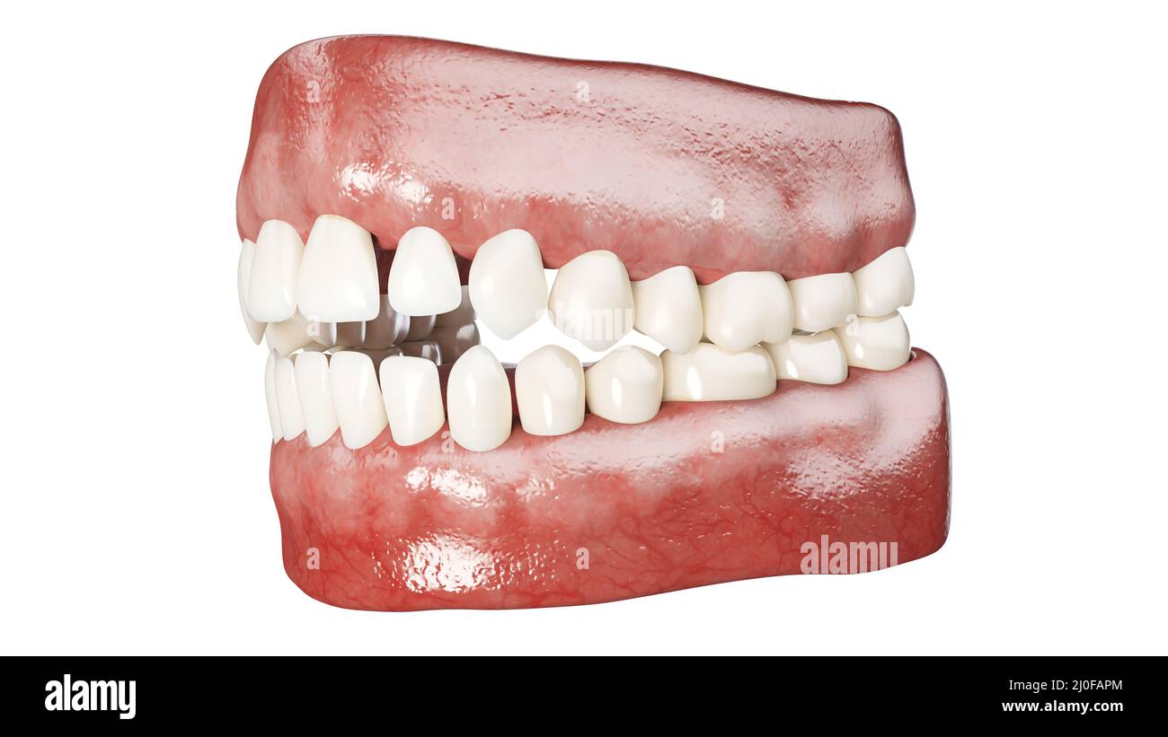 Open bite, illustration Stock Photo - Alamy