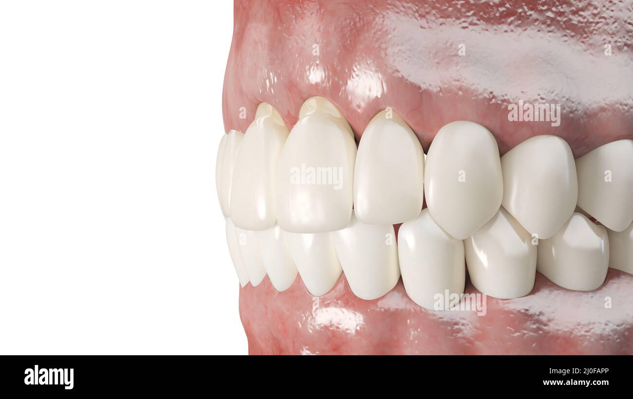 Gum recession hi-res stock photography and images - Alamy