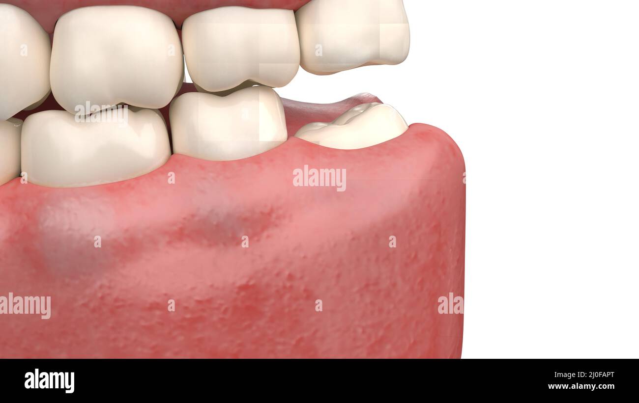 Impacted wisdom tooth, illustration Stock Photo - Alamy