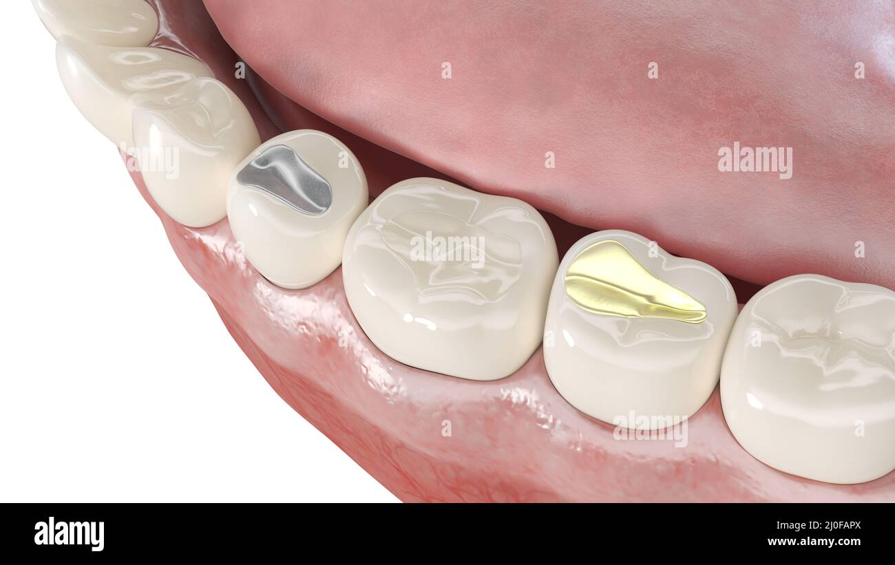 Different dental fillings, illustration Stock Photo - Alamy
