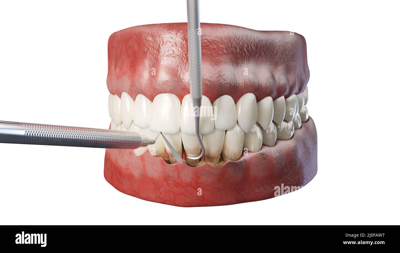 Dental root planing, illustration Stock Photo - Alamy