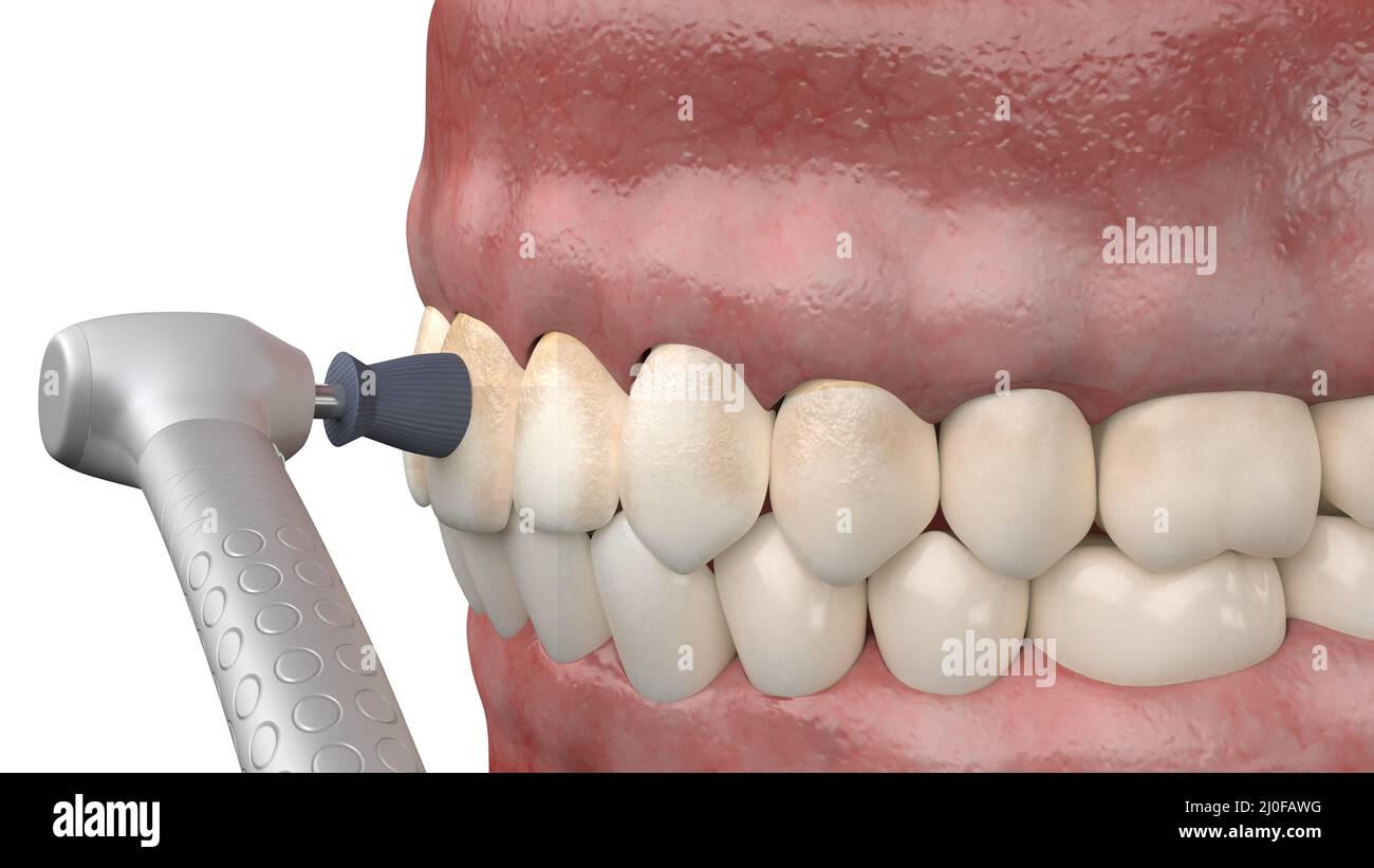 Polishing tooth hi-res stock photography and images - Alamy