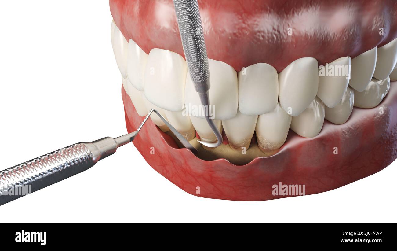 Dental root planing, illustration Stock Photo - Alamy