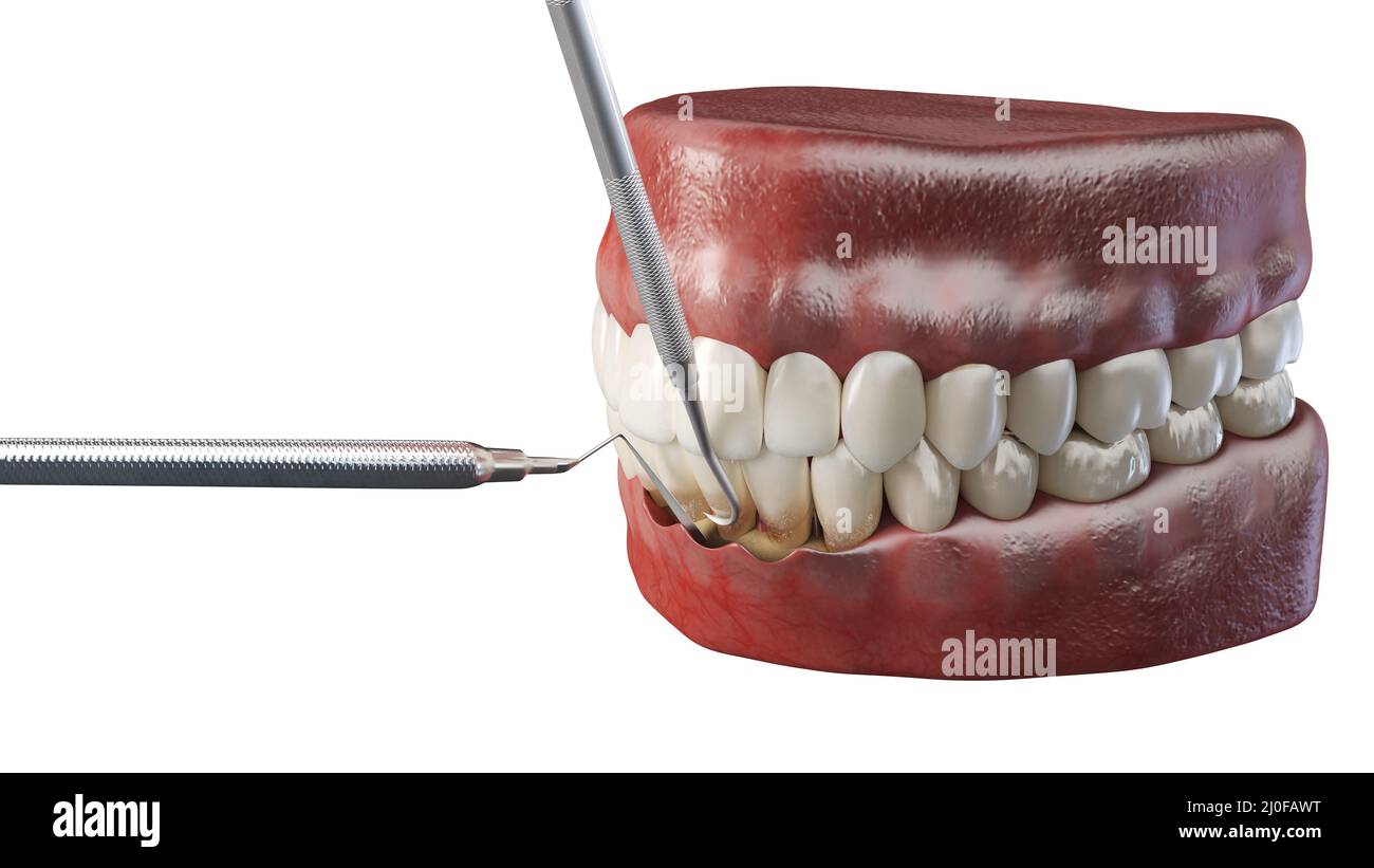 Dental root planing, illustration Stock Photo - Alamy