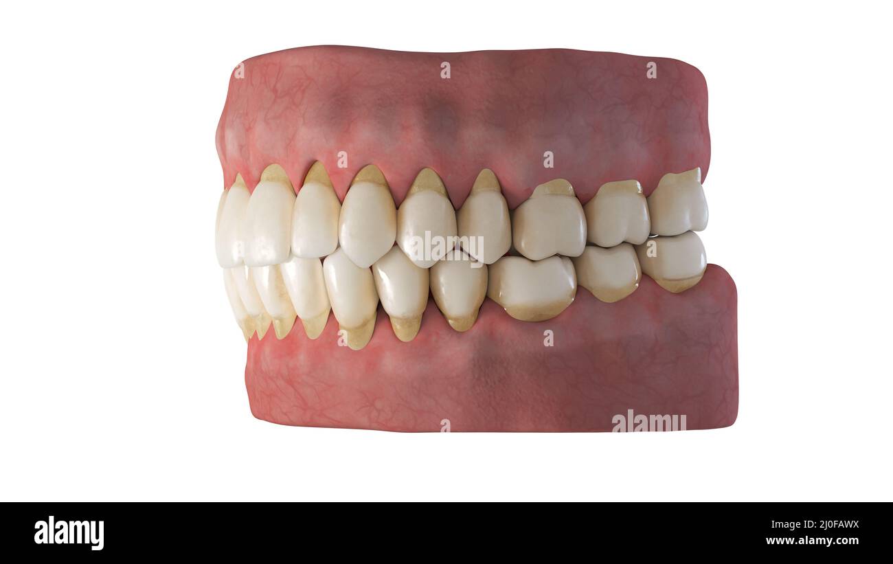 Periodontitis treatment hi-res stock photography and images - Alamy