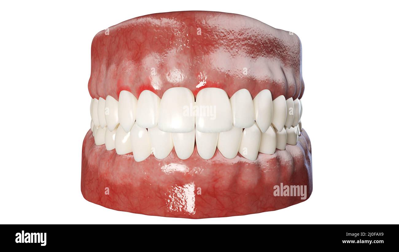 Periodontal disease, illustration Stock Photo - Alamy