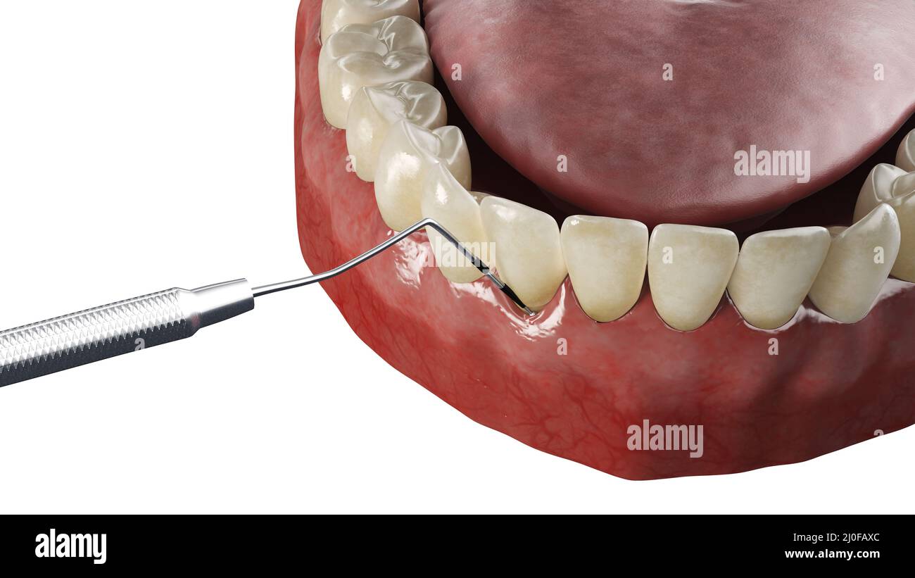 Periodontitis testing, illustration Stock Photo - Alamy