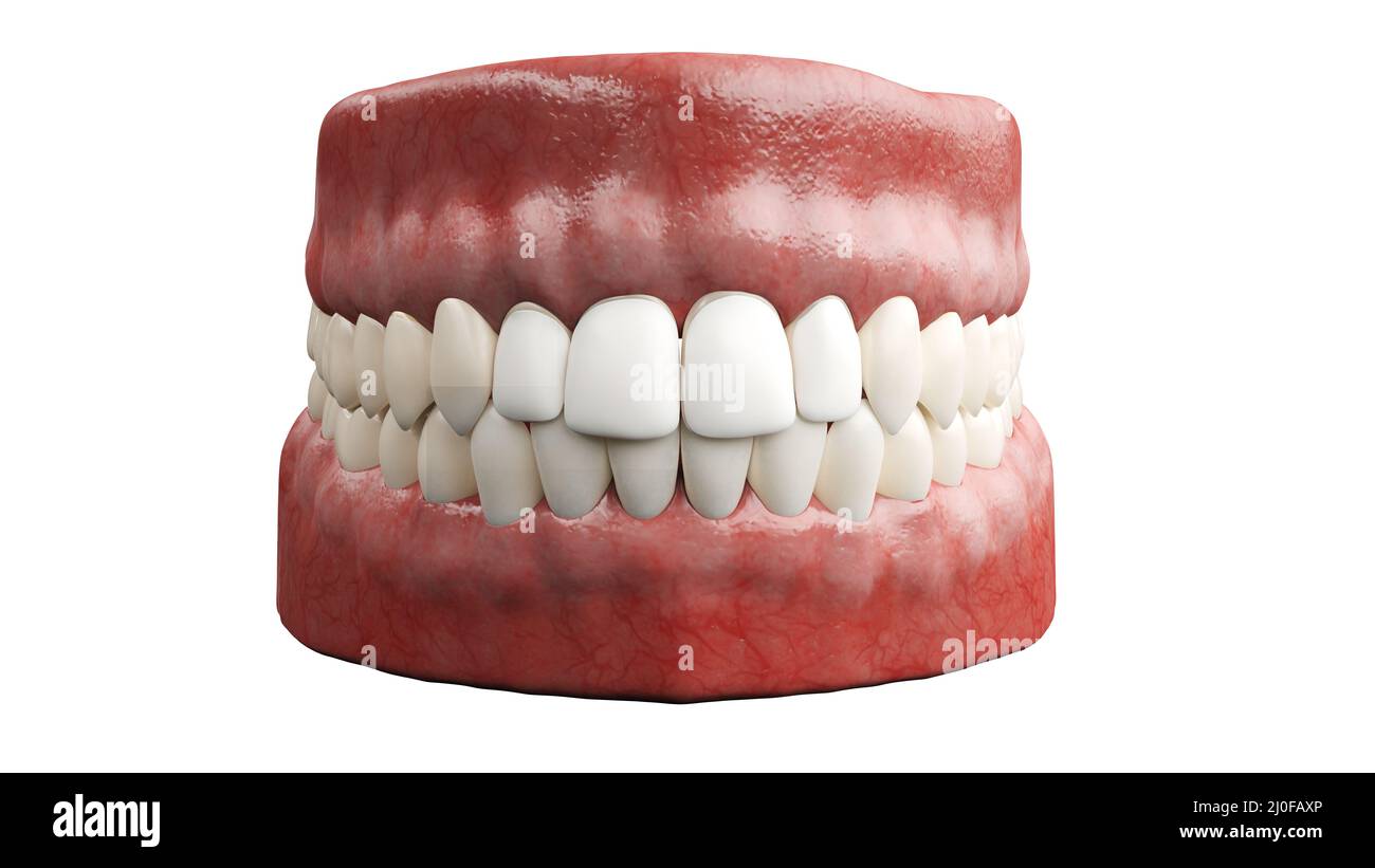 Dental veneers, illustration Stock Photo - Alamy