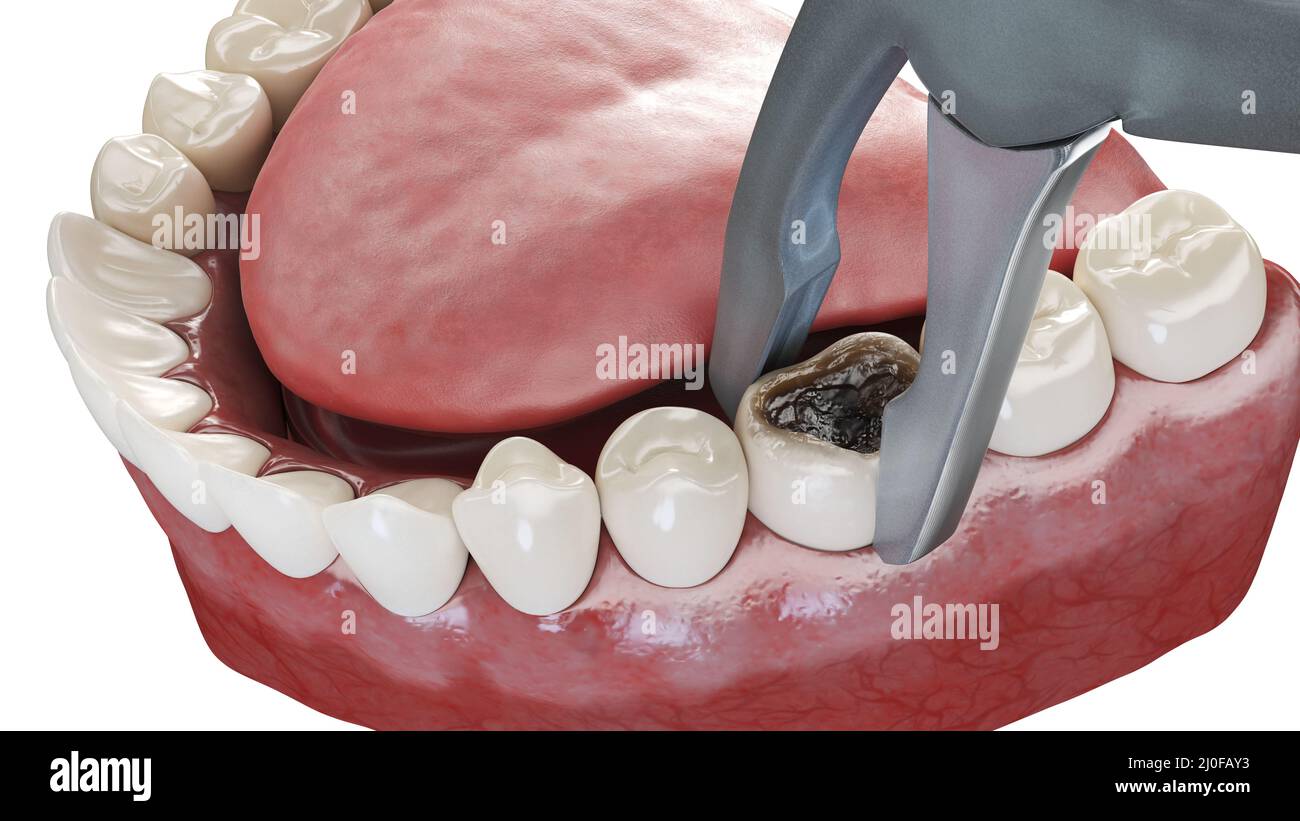 Tooth extraction, illustration Stock Photo - Alamy