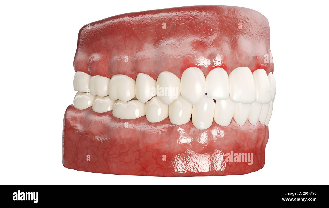 Periodontal disease 3d hi-res stock photography and images - Alamy