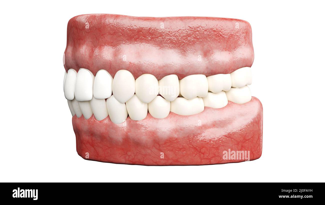 Dental veneers, illustration Stock Photo - Alamy