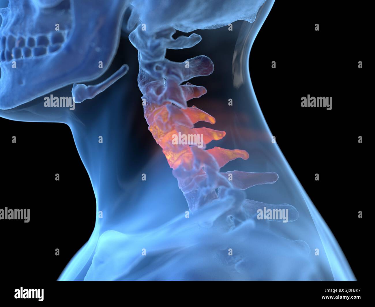 Inflamed neck, illustration Stock Photo - Alamy