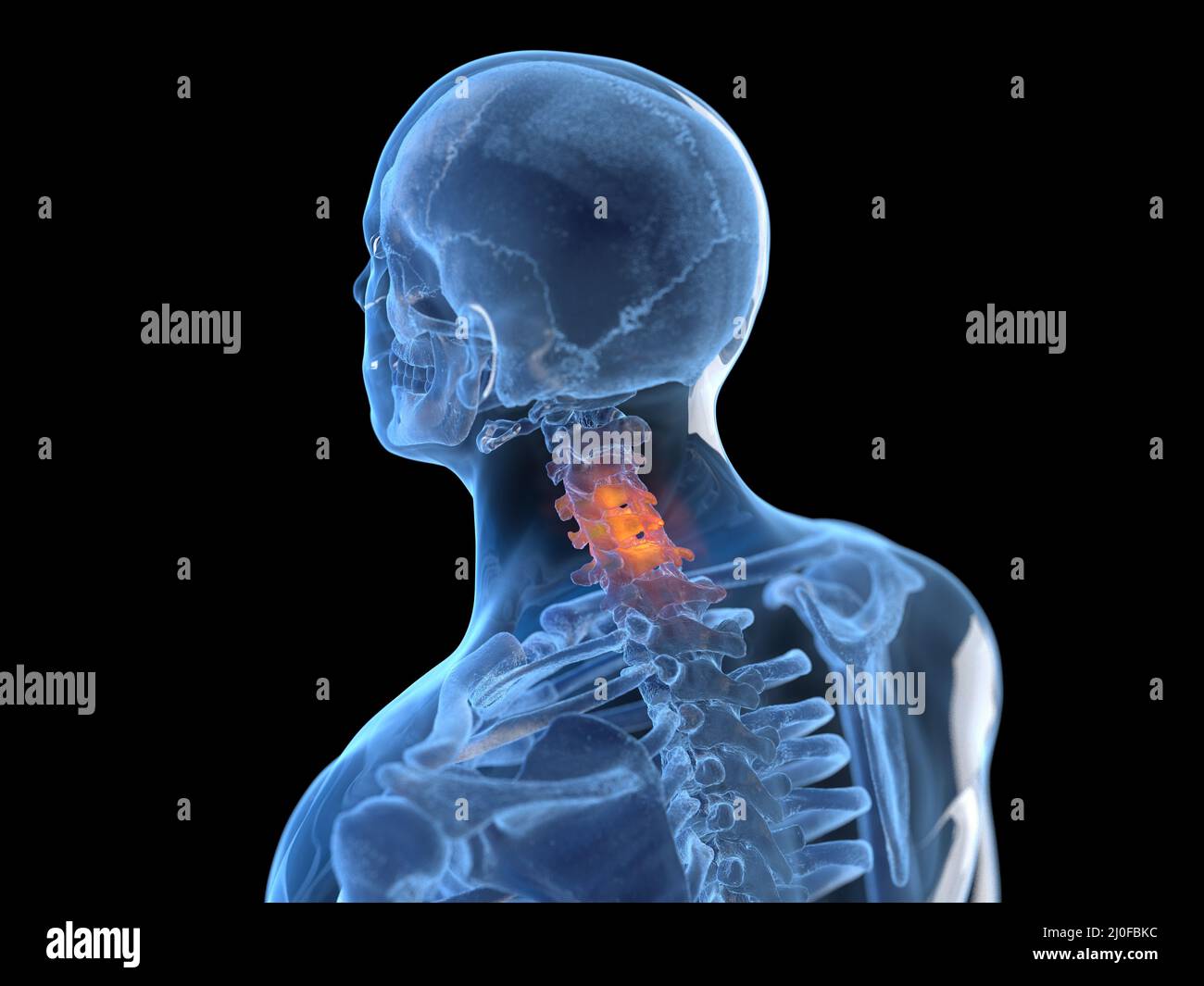Inflamed neck, illustration Stock Photo - Alamy