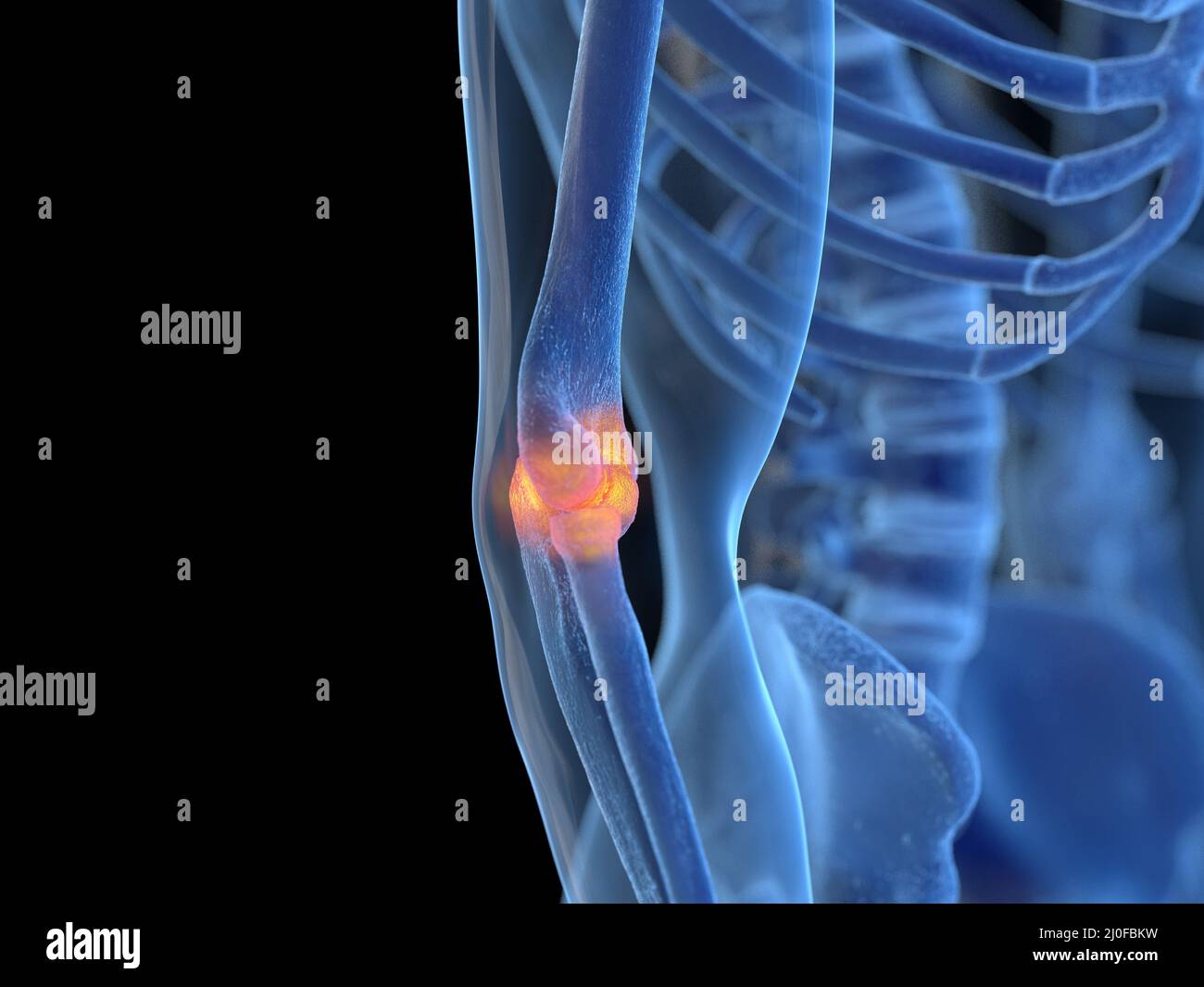 Inflamed elbow joint, illustration Stock Photo - Alamy