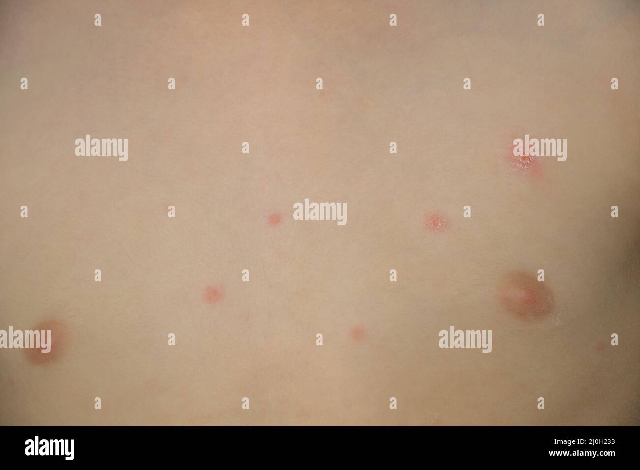 Chest of child affected by chickenpox. Toddler with red itchy pimples ...