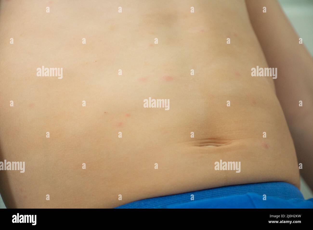 Pimples On Stomach