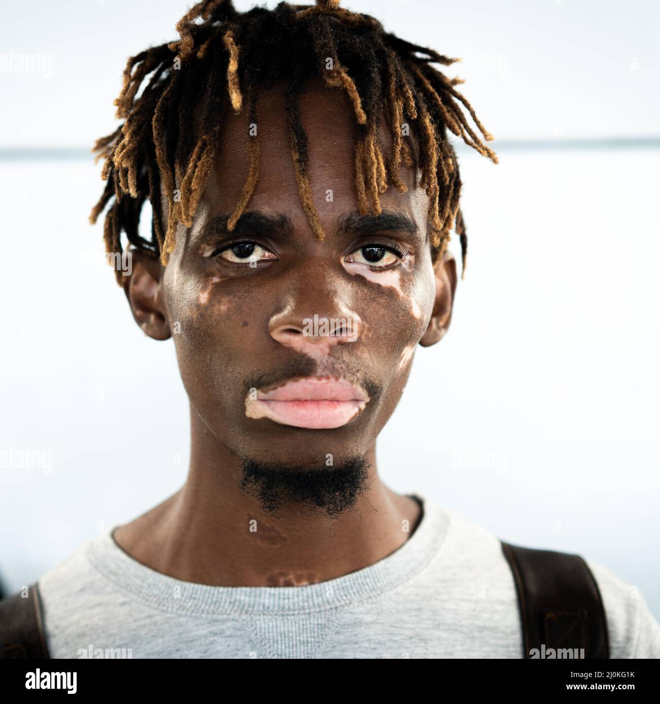 African American black young man with vitiligo skin pigment issue Stock ...