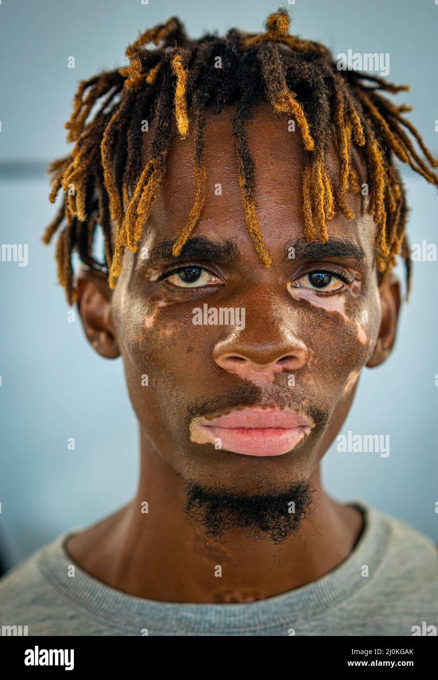 African vitiligo face hi-res stock photography and images - Alamy