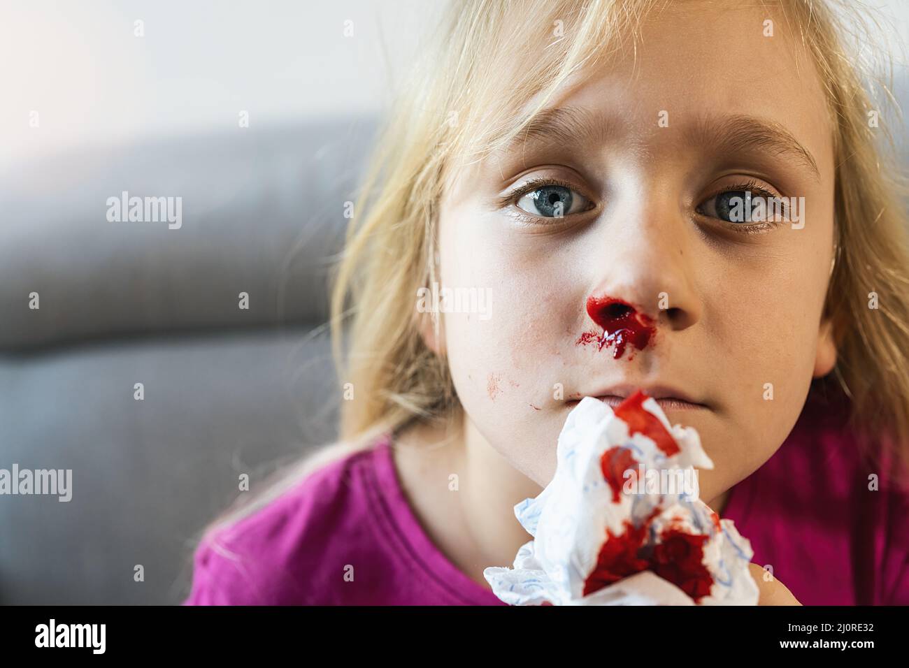 Child Trying To Stop Blood Bleeding From Nose. Epistaxis of a child ...