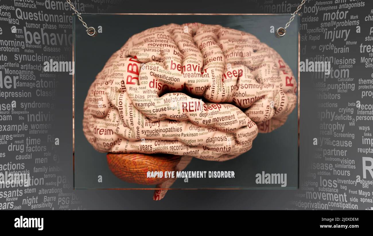 Rapid eye movement disorder anatomy - its causes and effects projected on a human brain ...
