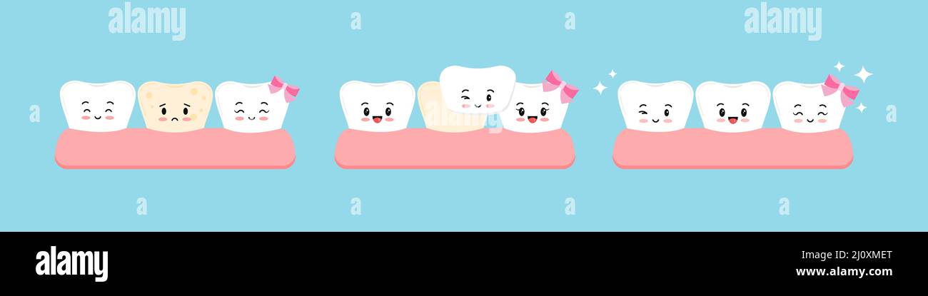 Cute white tooth, yellow and tooth with veneer stage Stock Vector Image ...