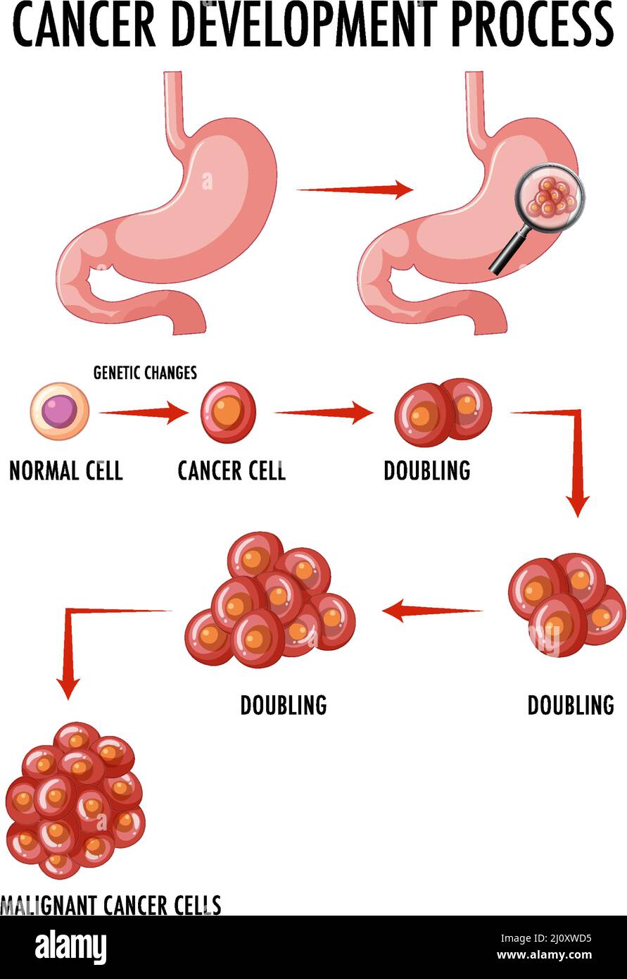 Diagram showing cancer development process illustration Stock Vector ...