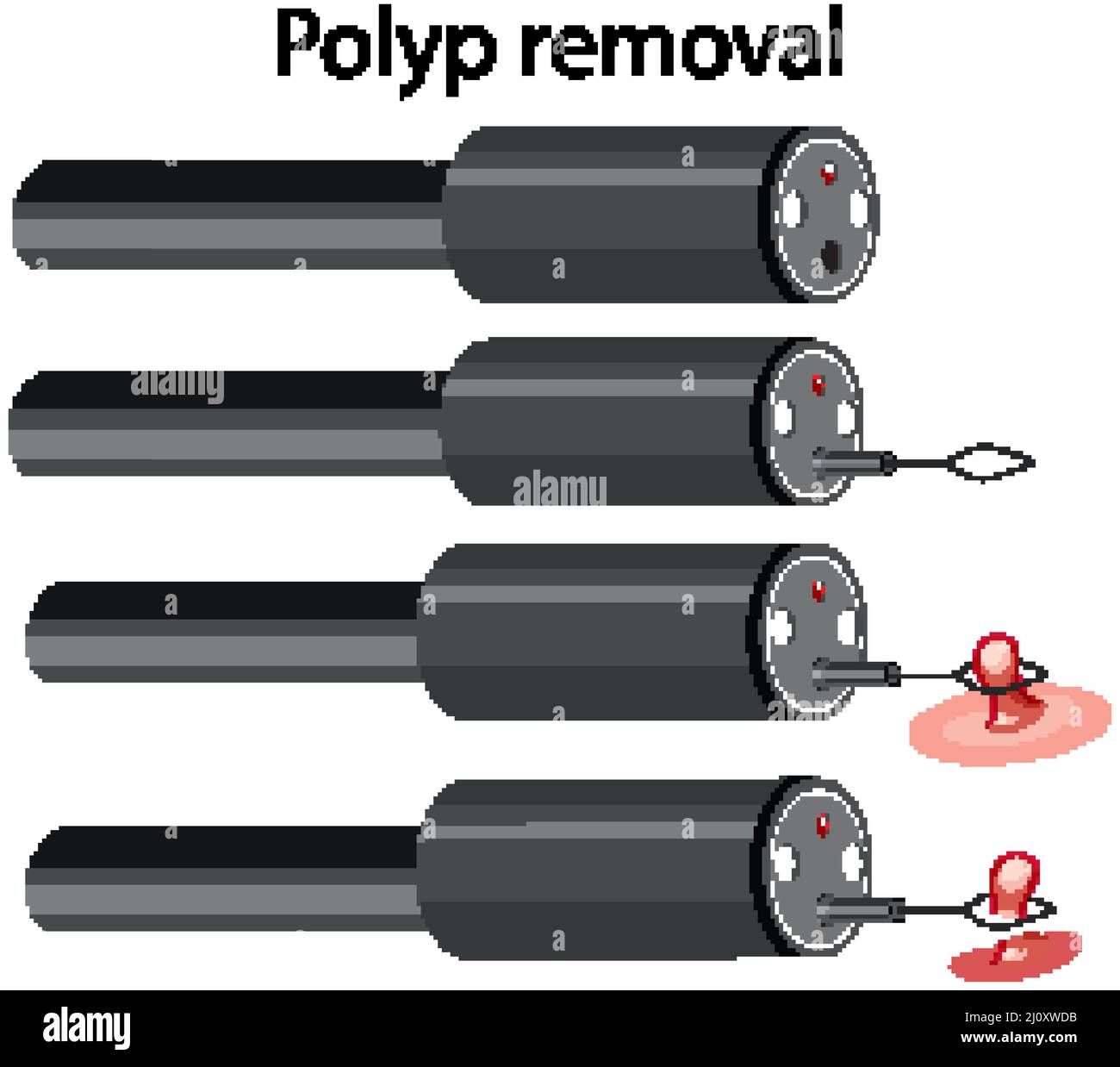 Diagram showing process of polyp removal illustration Stock Vector ...