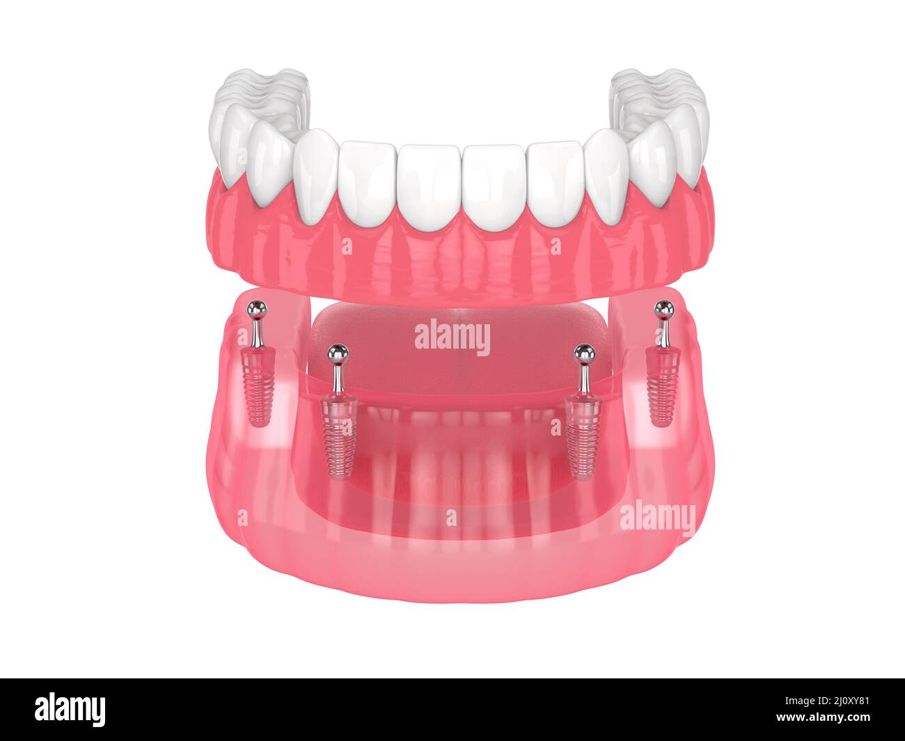 All-on-4 removable, implants supported, overdenture installation over ...