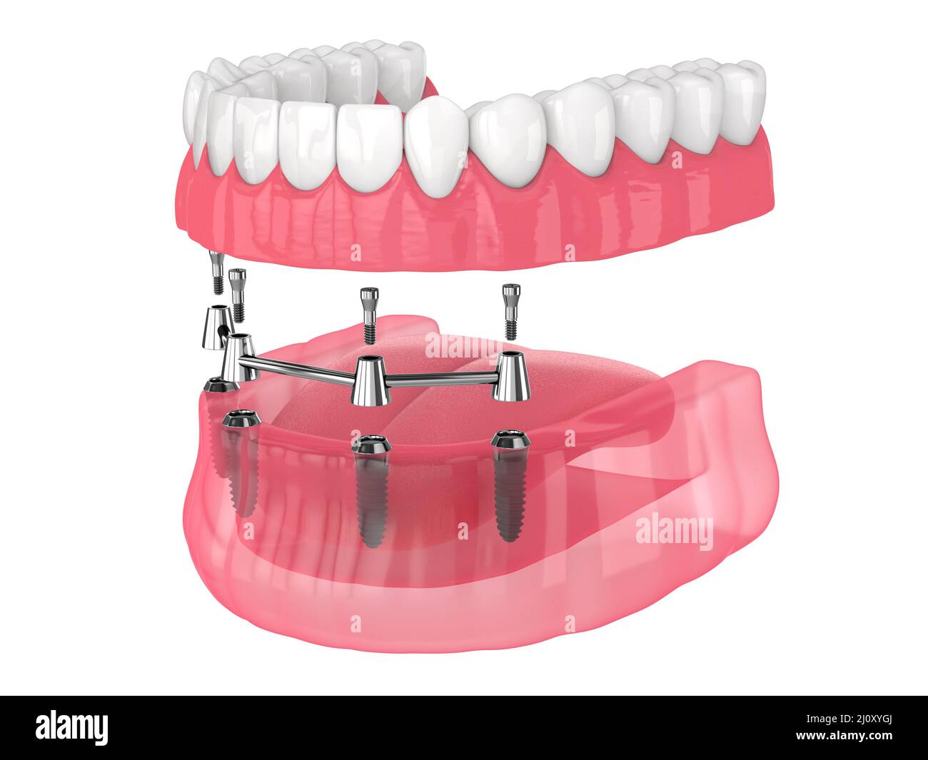 Removable overdenture installation on bar clip attachment, supported by ...