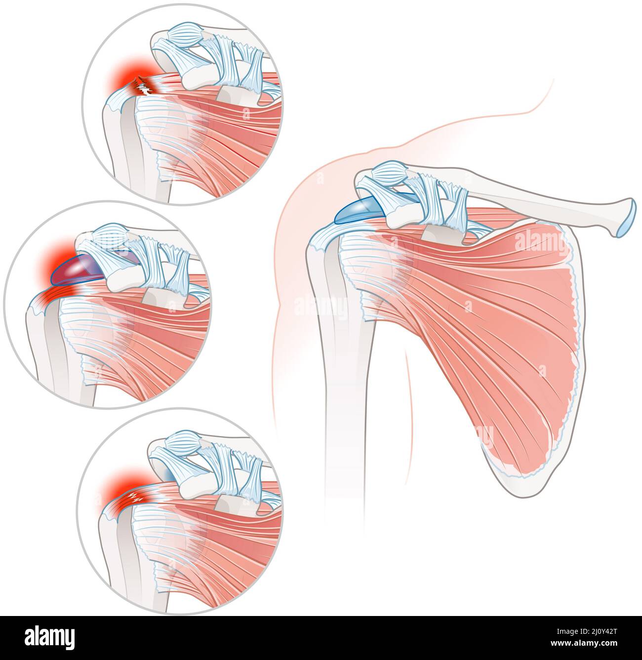 Illustration showing shoulder rotator cuff disease illustration Stock ...