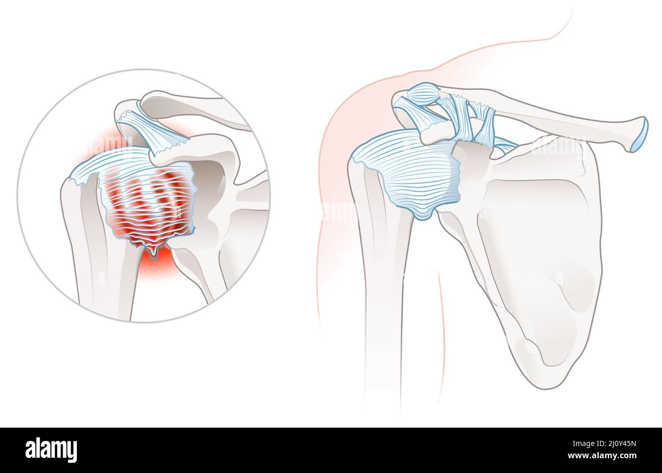 Illustration showing frozen shoulder adhesive capsulitis illustration ...