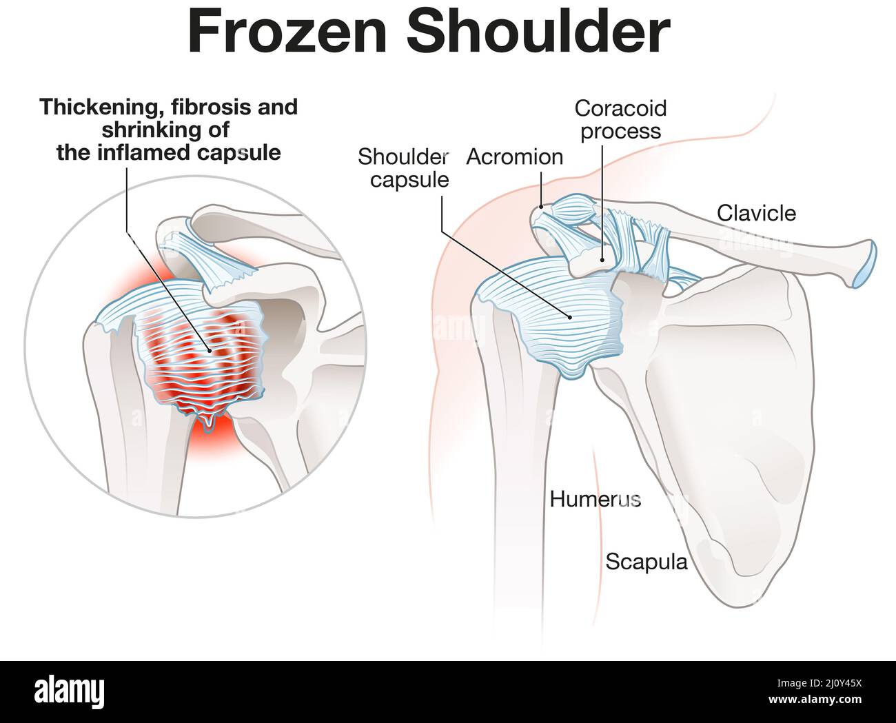 Illustration showing frozen shoulder adhesive capsulitis illustration ...
