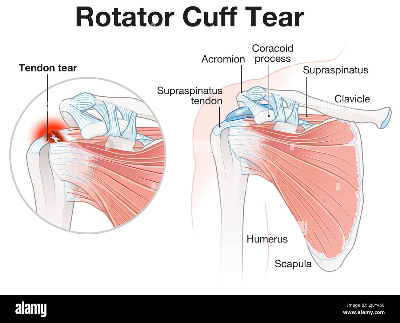 Illustration showing rotator cuff tear shoulder illustration Stock ...