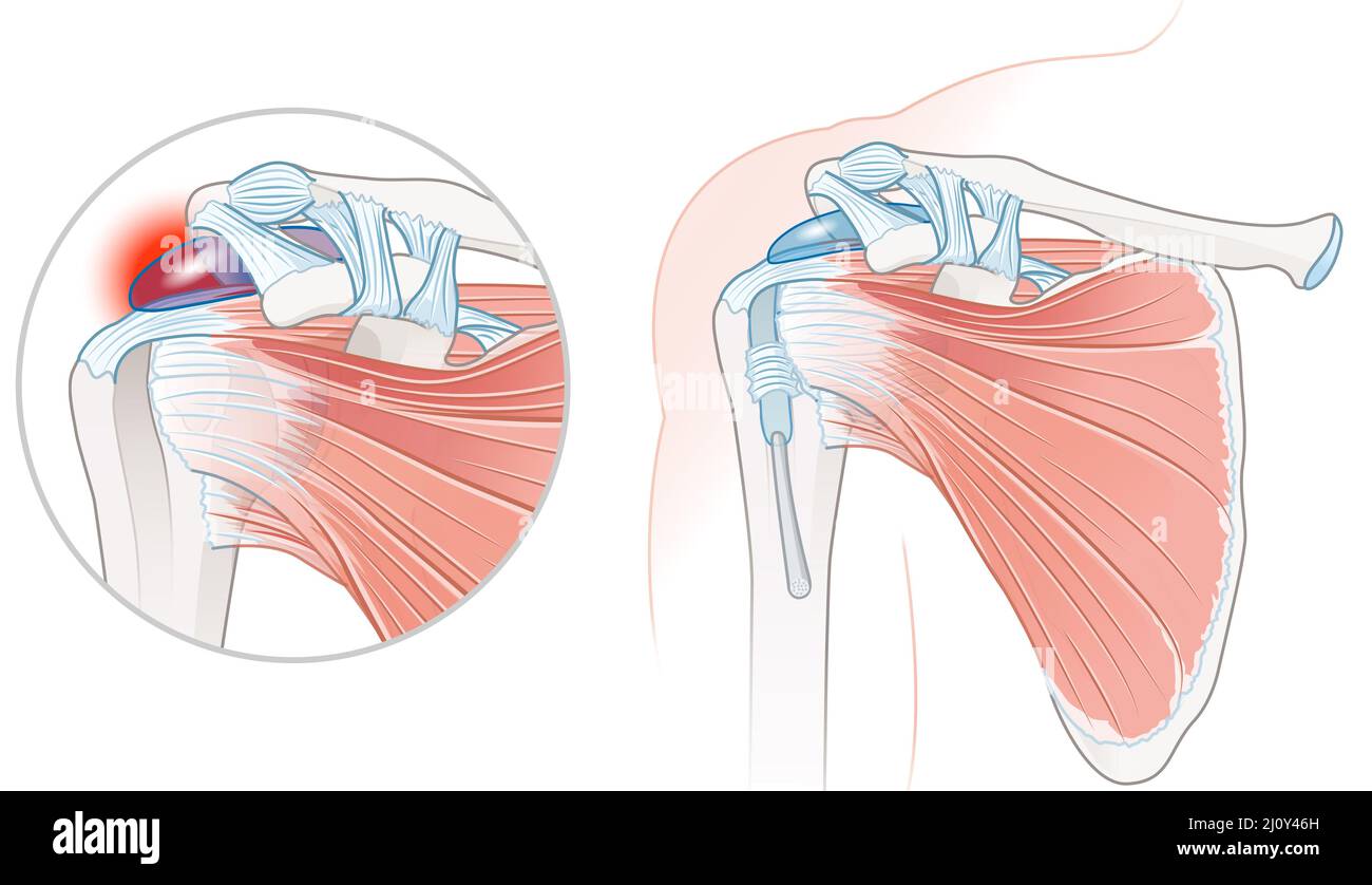 Illustration showing rotator cuff bursitis Stock Photo - Alamy Illustration showing rotator cuff bursitis Stock Photo - Alamy