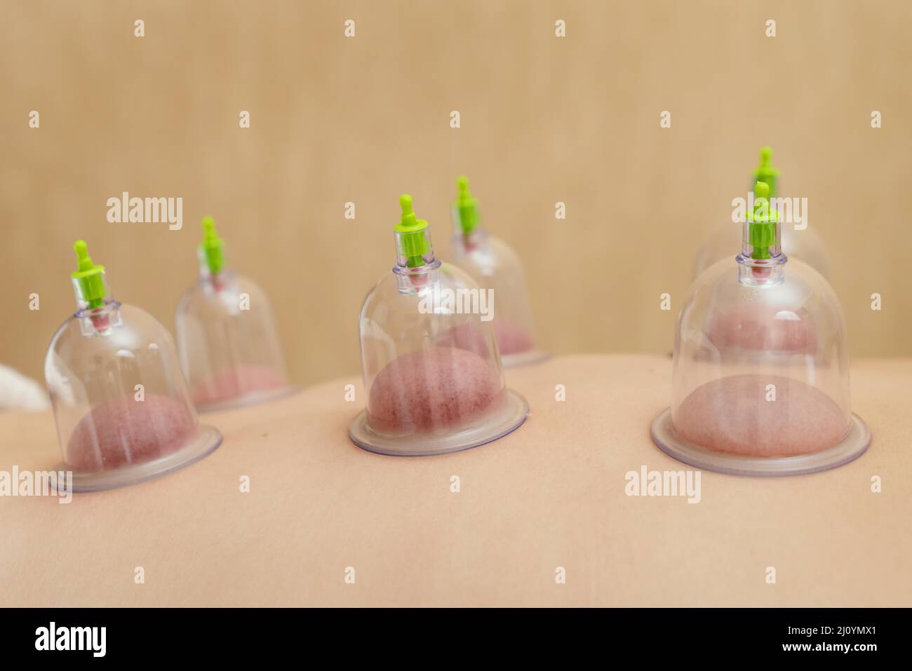 Cupping therapy hand hi-res stock photography and images - Alamy