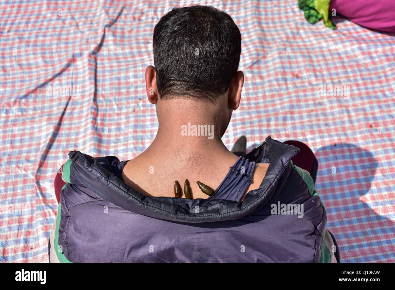 Srinagar, India. 21st Mar, 2022. A patient receives leech therapy ...