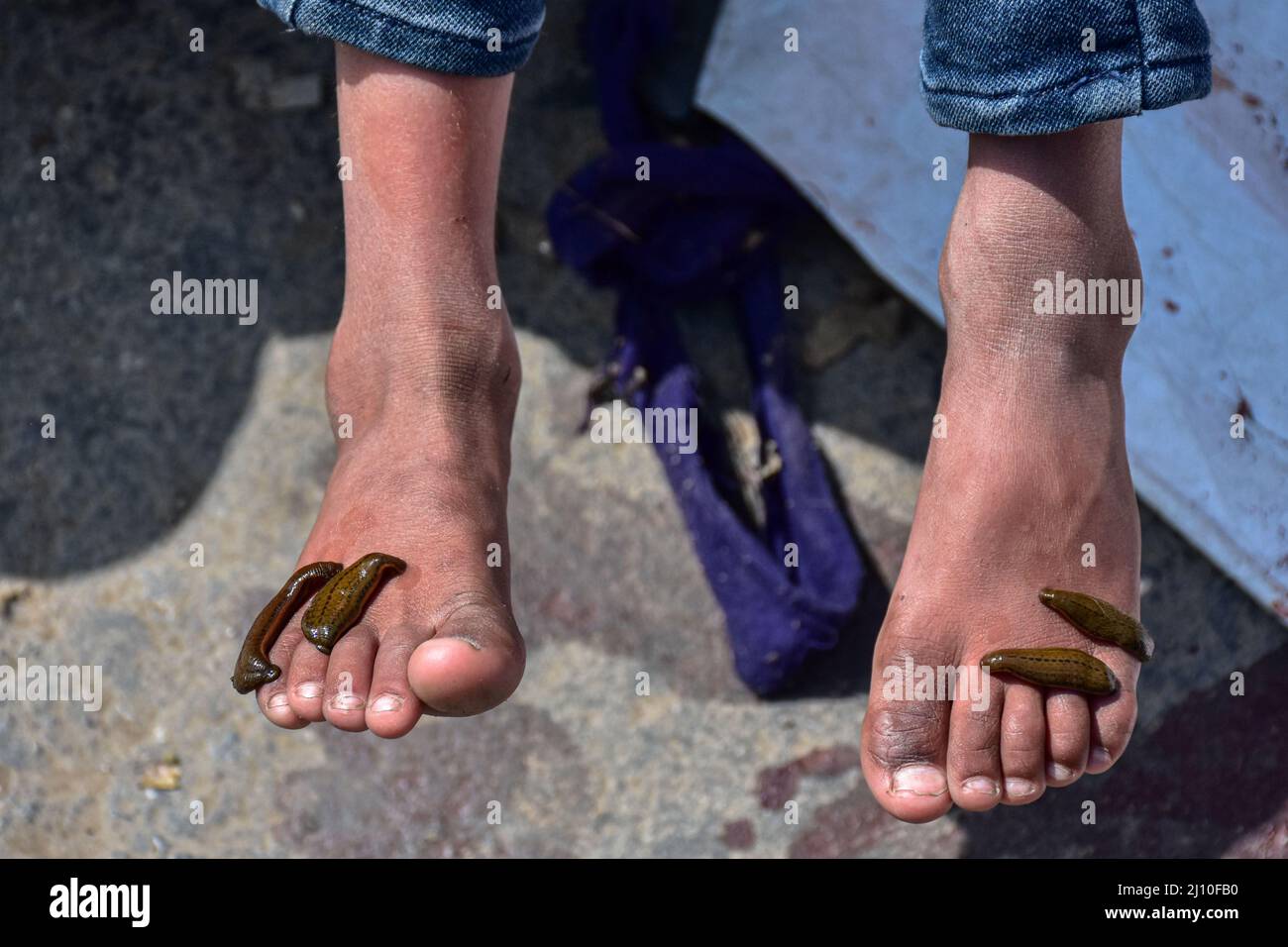 Srinagar, India. 21st Mar, 2022. A patient receives leech therapy ...