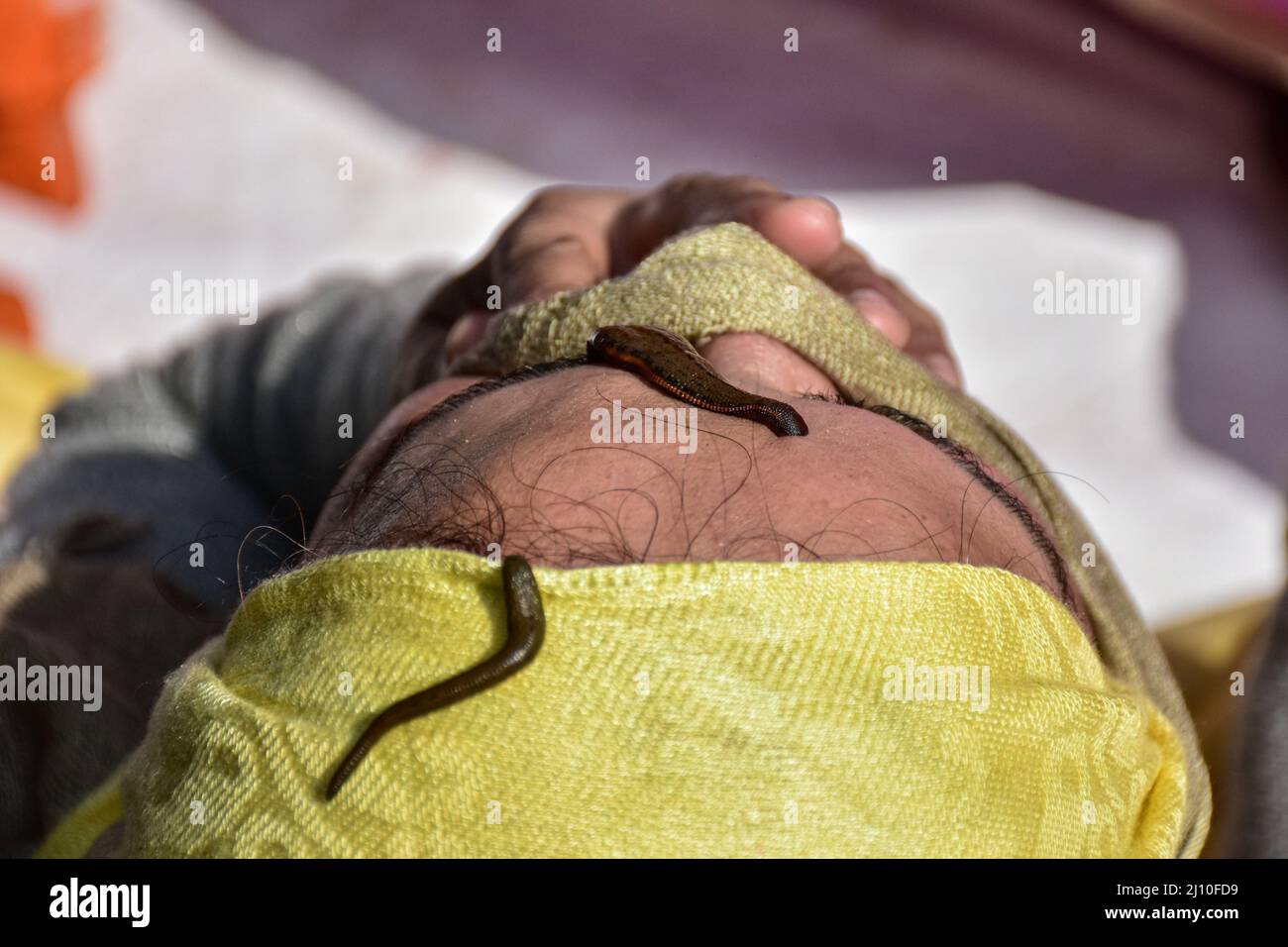 Srinagar, India. 21st Mar, 2022. A patient receives leech therapy ...
