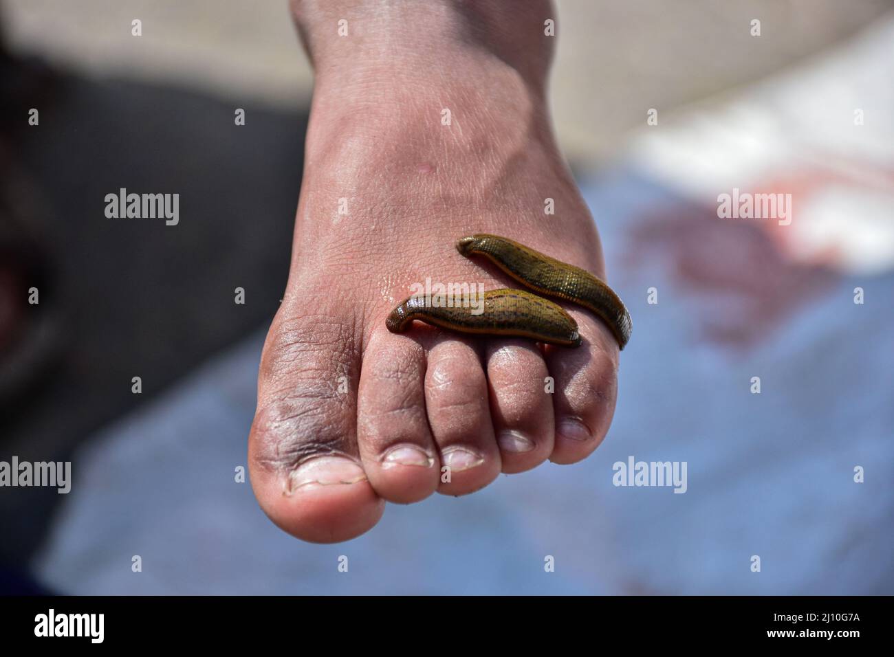 Srinagar, India. 21st Mar, 2022. A patient receives leech therapy ...