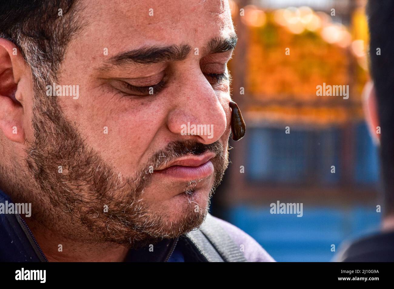 Srinagar, India. 21st Mar, 2022. A patient receives leech therapy ...