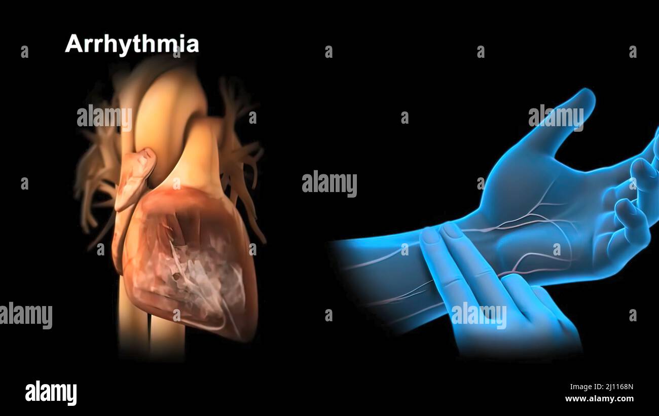Abnormal Heart Rhythm High Resolution Stock Photography and Images - Alamy