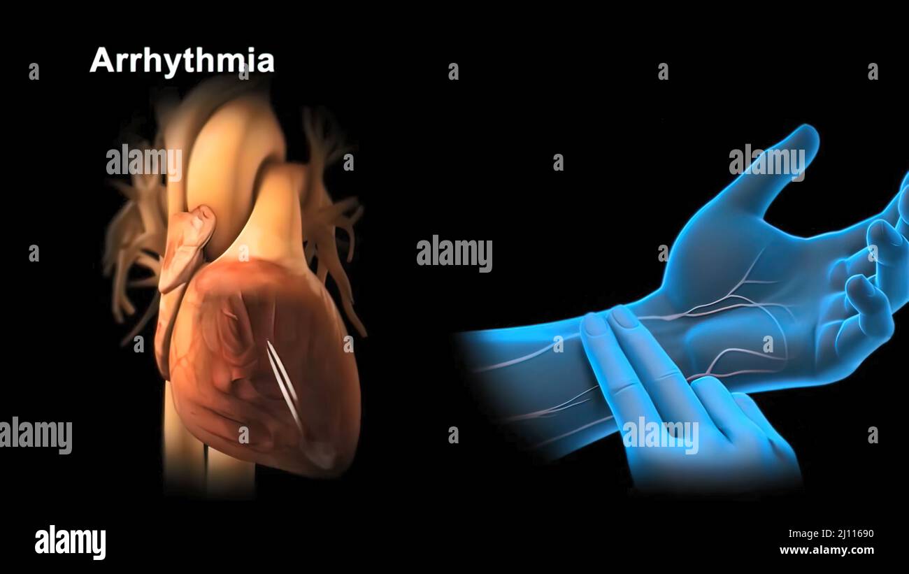 Abnormal Heart Rhythm High Resolution Stock Photography and Images - Alamy