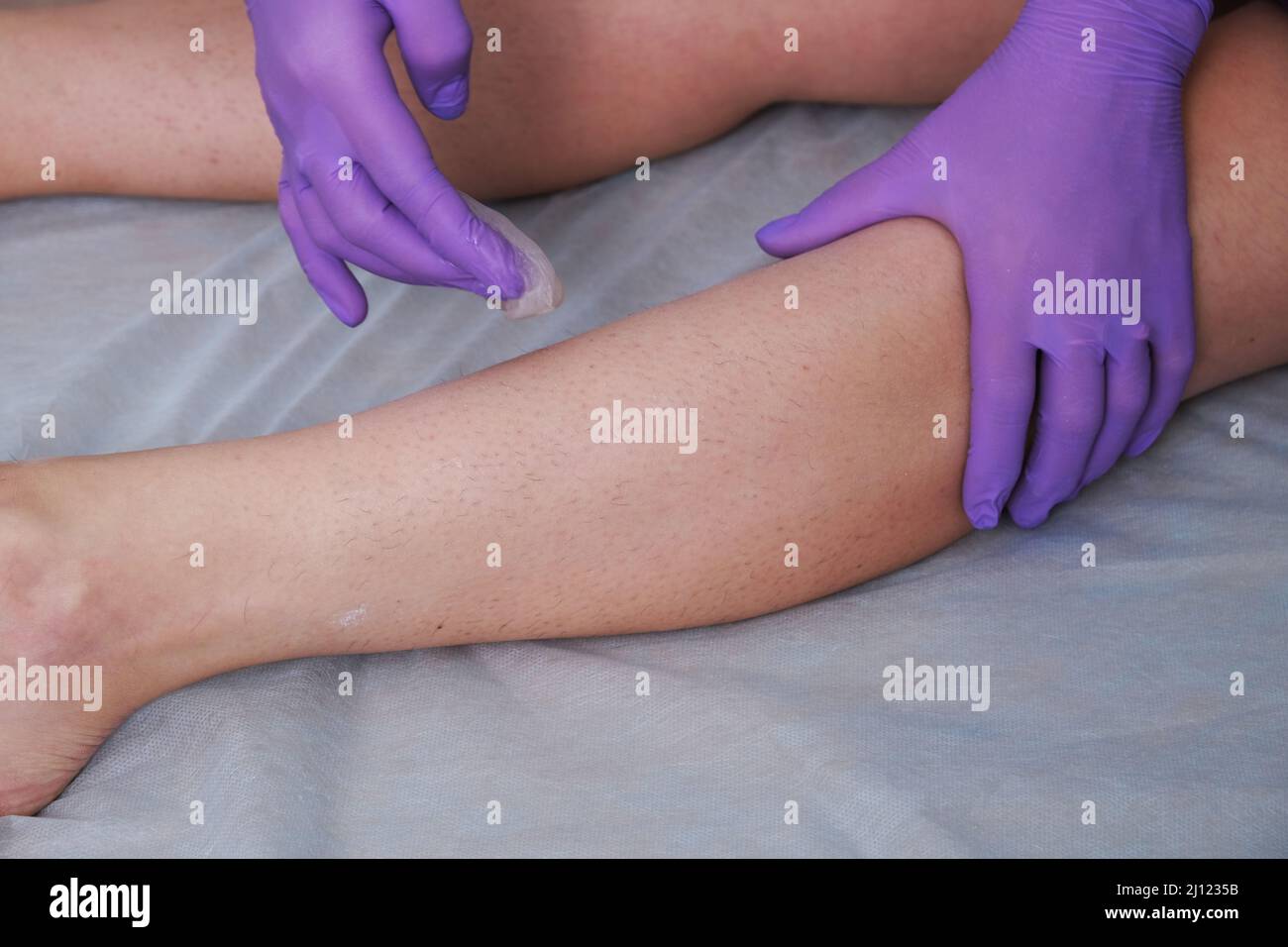 Sugaring epilation skin care with liquid sugar at legs Stock Photo - Alamy