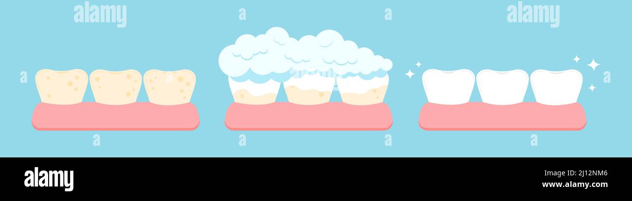 Tooth with yellow plaque, whitening stage and shiny tooth in gum before ...