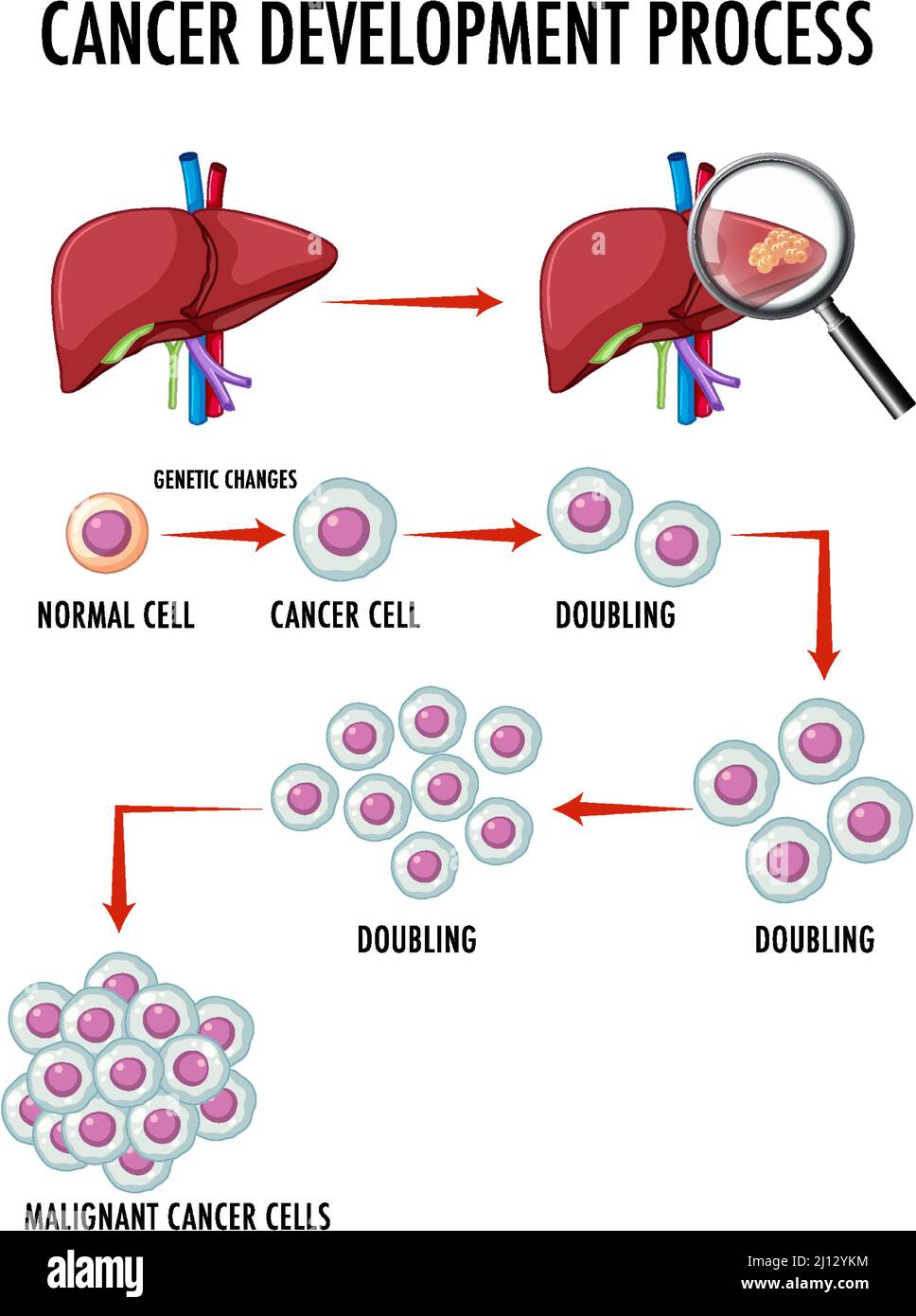 Diagram showing cancer development process illustration Stock Vector ...