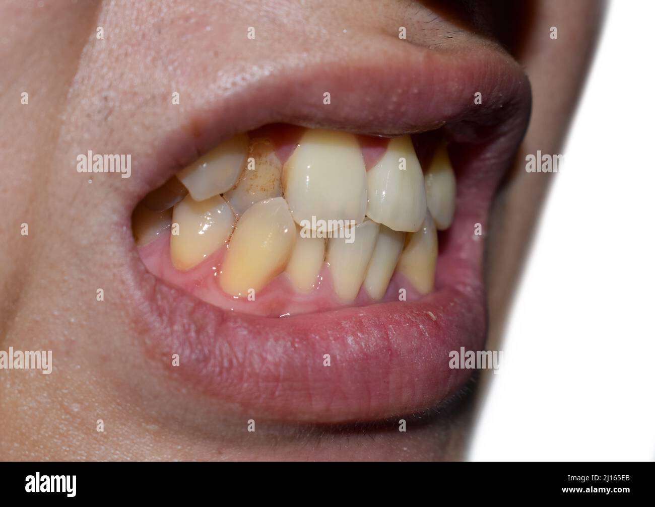Stacked or overlapping teeth with yellow stain of Asian man. Also ...