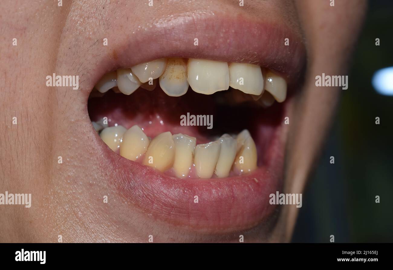 Stacked or overlapping teeth with yellow stain of Asian man. Also ...